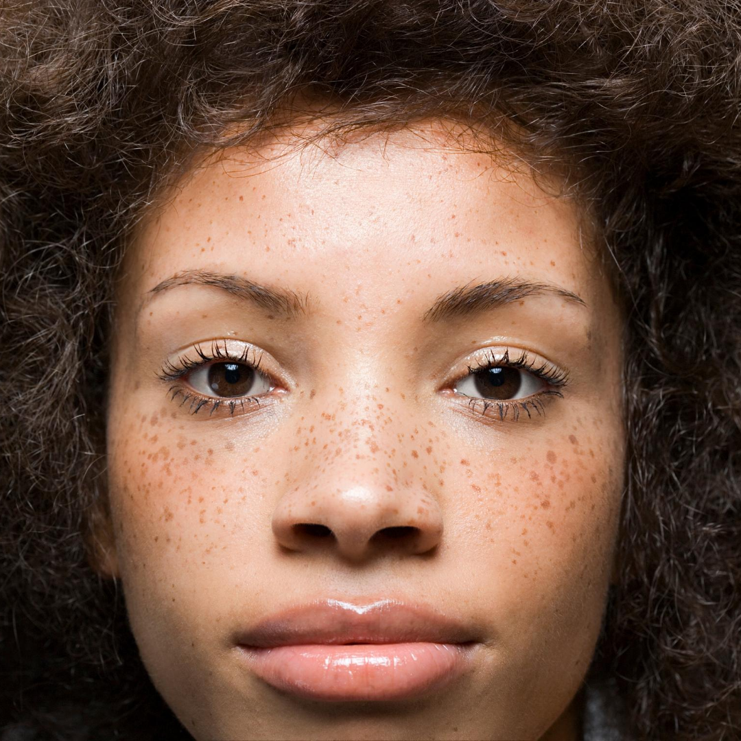 Freckling, la polémica moda de tatuarse pecas