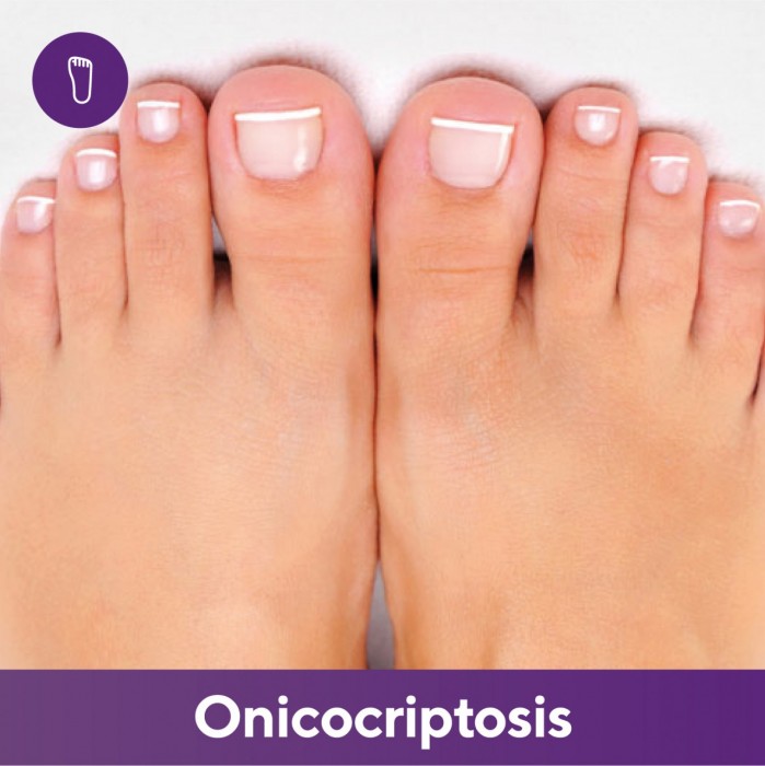 Onicocriptosis - Alta Capacitación Profesional