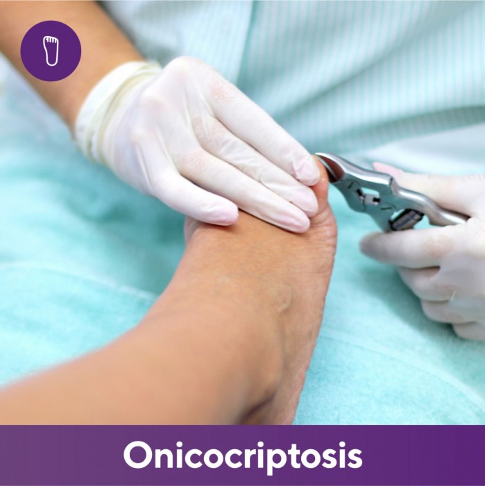 Onicocriptosis - Alta Capacitación Profesional